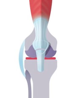 Meniskus, Sehnen und Bänder: So bleiben sie gesund | STERN.de