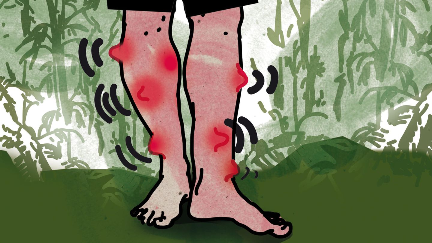Die Diagnose: In den roten Beulen an den Beinen bewegte sich etwas ...
