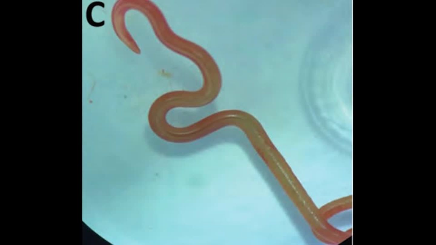 Lebendiger Wurm in Gehirn von Frau entdeckt