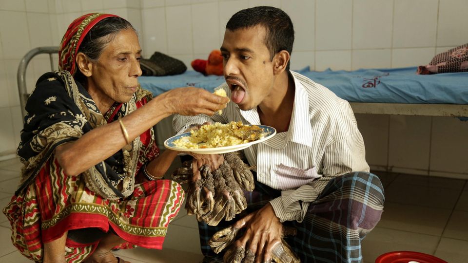 "Baummann" in Bangladesch: "Habe die Ärzte gebeten, meine Hände ...