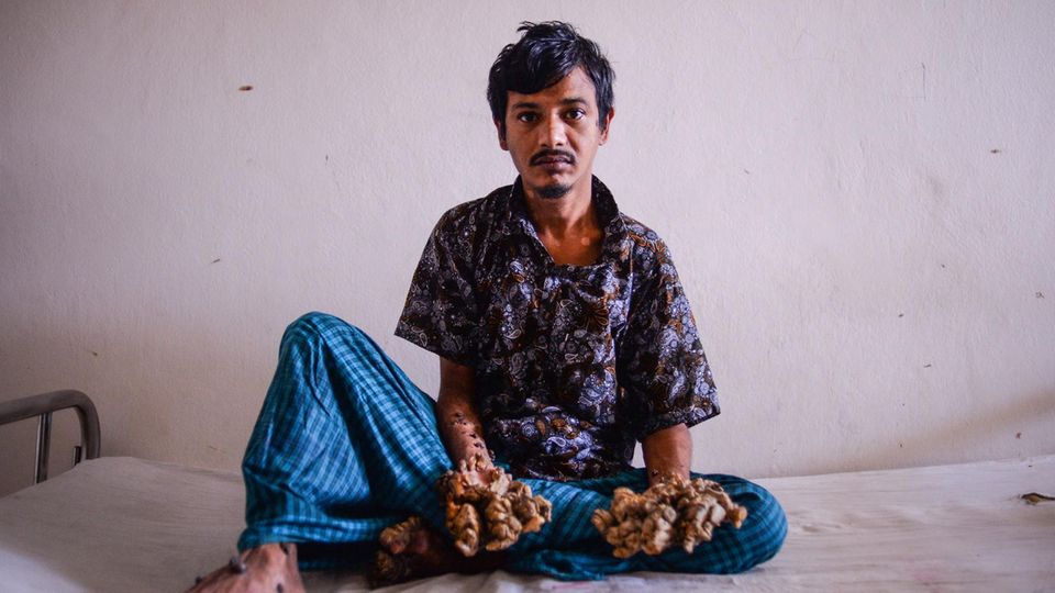 "Baummann" in Bangladesch: "Habe die Ärzte gebeten, meine Hände ...